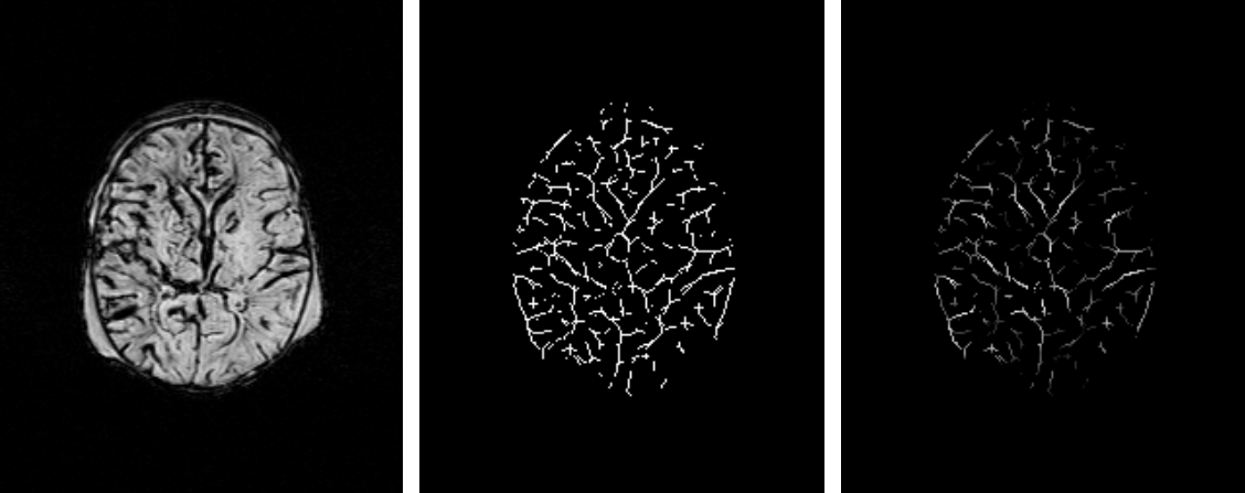 MRI Analysis for HIE Diagnosis